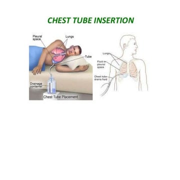 Chest Tube Insertion clinical based presentation | PPTX
