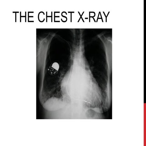 Chest x ray | PPT