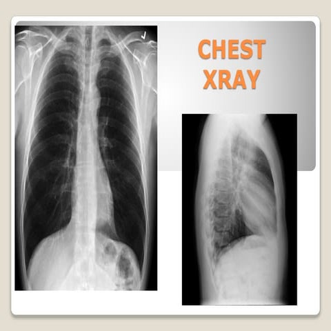 CHEST XRAY RDG 303.pptx