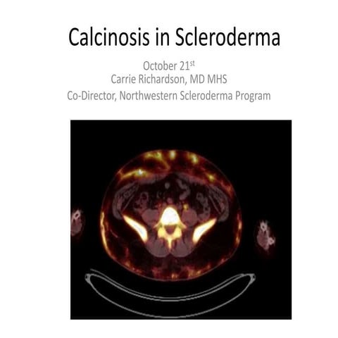 Scleroderma & the hands - Calcinosis | PPT