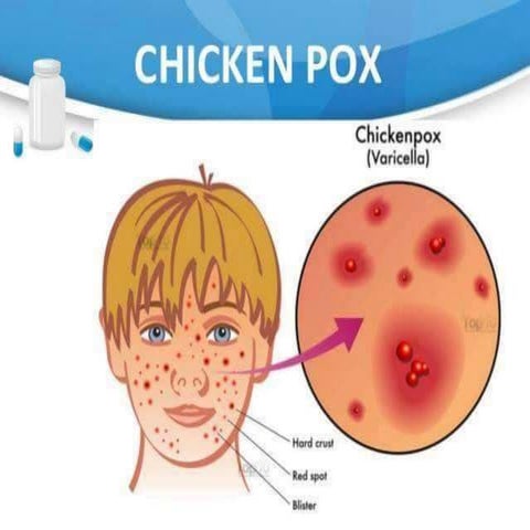 CHICKENPOX ppt | PPTX