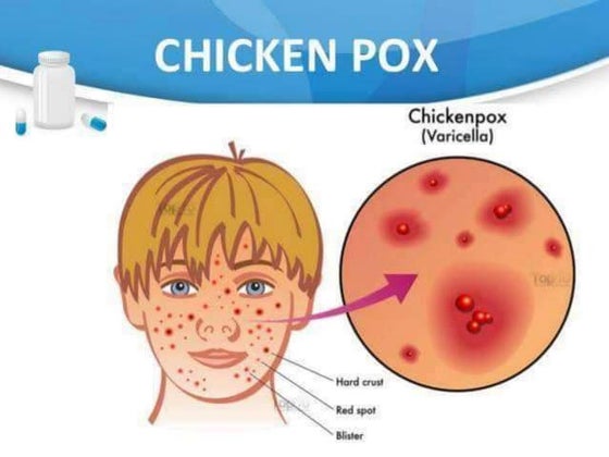 CHICKENPOX ppt | PPT