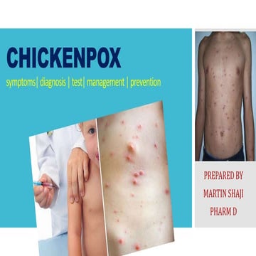 Chickenpox -symptoms |tests |management ( medical information ) | PPTX