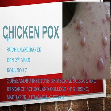 CHICKENPOX ppt | PPTX