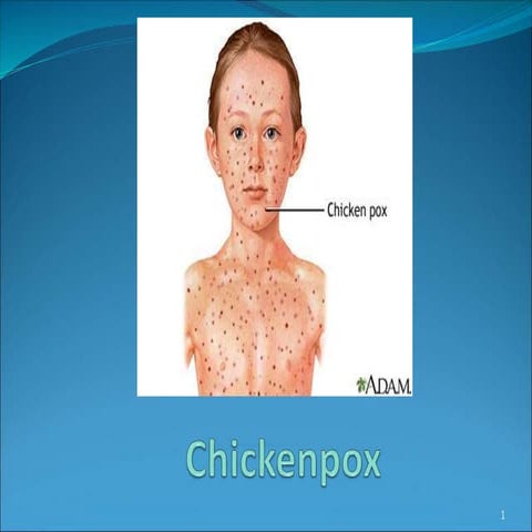 Chickenpox.ppt