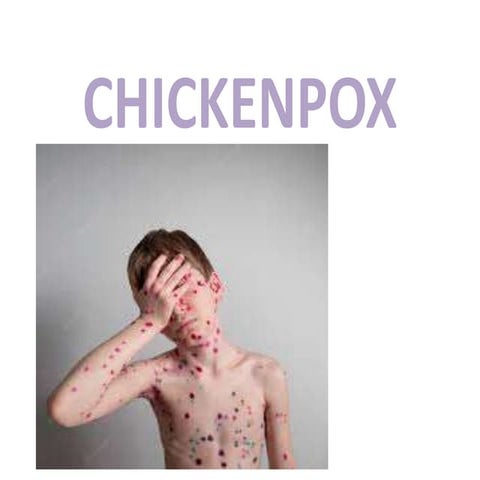 COMMUNICABLE DISESE, CHICKEN POX ADULT HEALTH NURSING PPT | PPTX