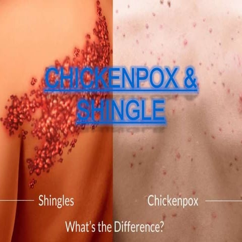 chickenpox & shingles.ppt