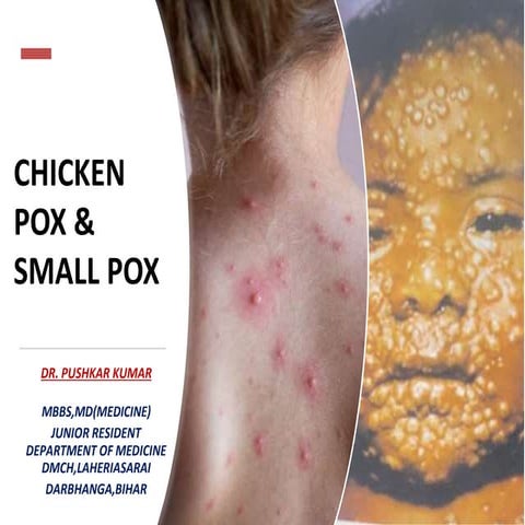 Chicken Pox & Small Pox.pptx