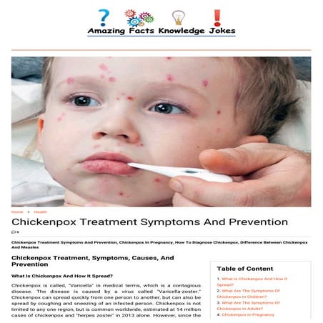 Chickenpox Treatment Guidelines – BYOFB