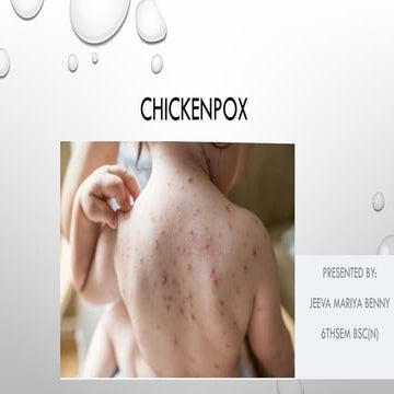 chikenpox presentation original original.pptx