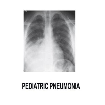 Bronchopneumonia | PPTX