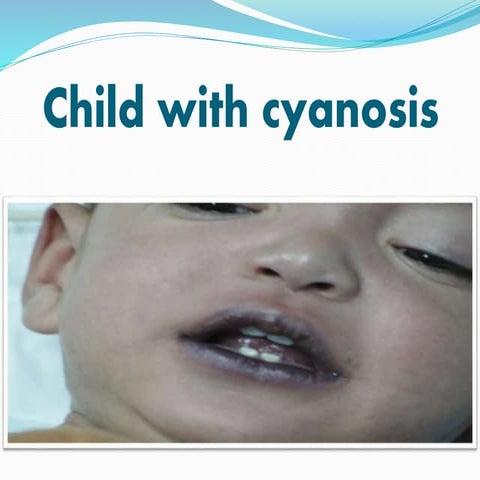 Approach to the neonatal cyanosis