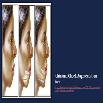 Chin and cheek augmentation | PPTX