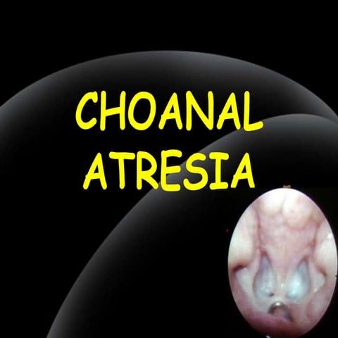 Choanal atresia in children | PPTX