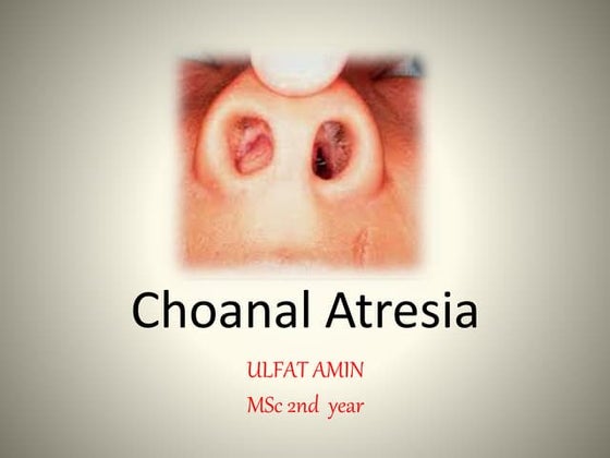 Choanal Atresia Choanal Atresia In Adult Endoscopic Surgery And