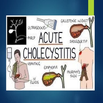 Gall bladder & biliary tract anomalies and variants | PPTX