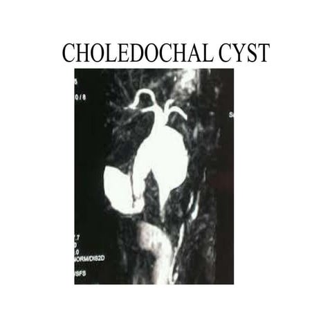 Choledochal cyst | PPTX
