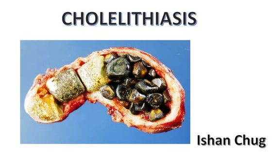 Cholelithiasis (Gall stone) | PPT