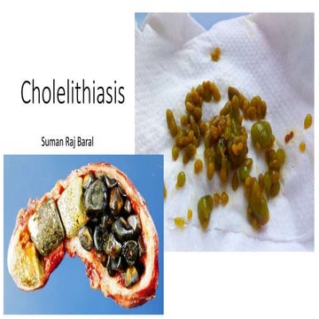 Cholelithiasis at a glance- 1 | PPT