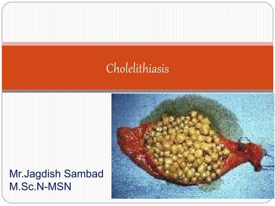 Cholelithiasis | PPT