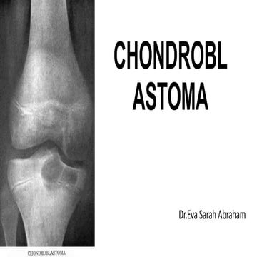 Chondroblastoma | PPTX