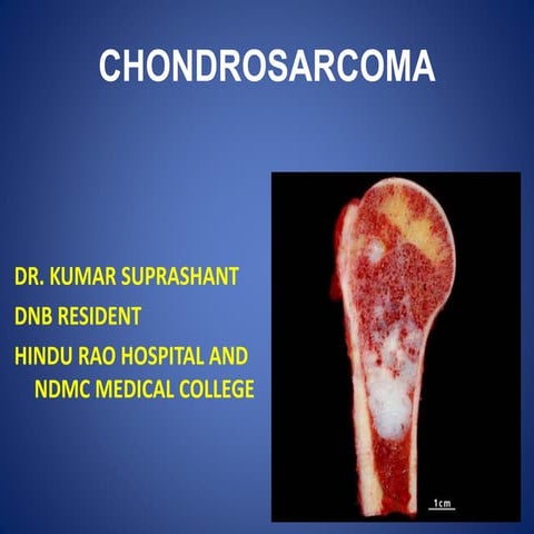 Chondrosarcoma | PPTX