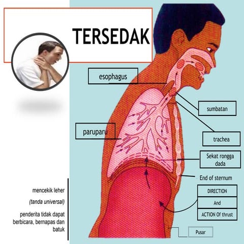 Tersedak | PPT