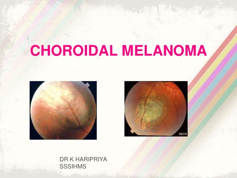 Choroidal melanoma
