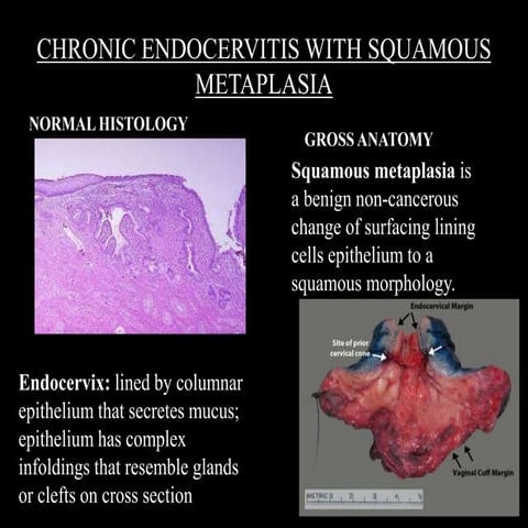 Chronic endocervitis with squamous metaplasia | PPTX