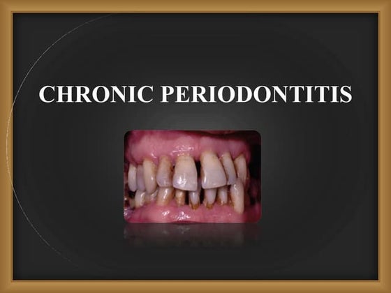 Gingival and periodontal disease in children | PPT
