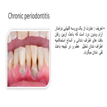 Chronic periodontitis.pptx