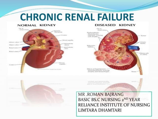 Renal Failure Virta's Approach Improves Kidney Function, Offering Hope Renal Failure Virta's Approach Improves Kidney Function, Offering Hope