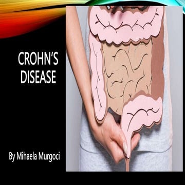 Chron’s disease.pptx