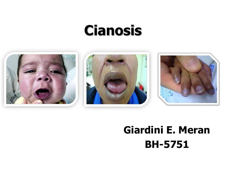 Cianosis