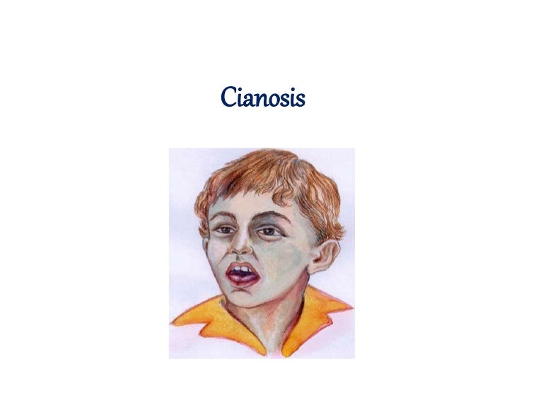 Cianosis