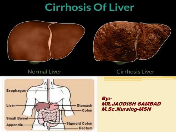 Case presentation on Decompensated Chronic Liver Disease (Non Alcoholic ...