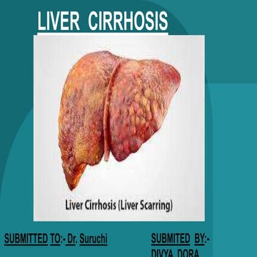 Case presentation on Decompensated Chronic Liver Disease (Non Alcoholic ...