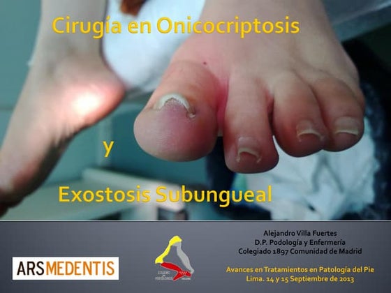 Onicocriptosis Podologia Facultad de Medicina UBA | PDF