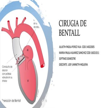 Procedimiento de bentall bono