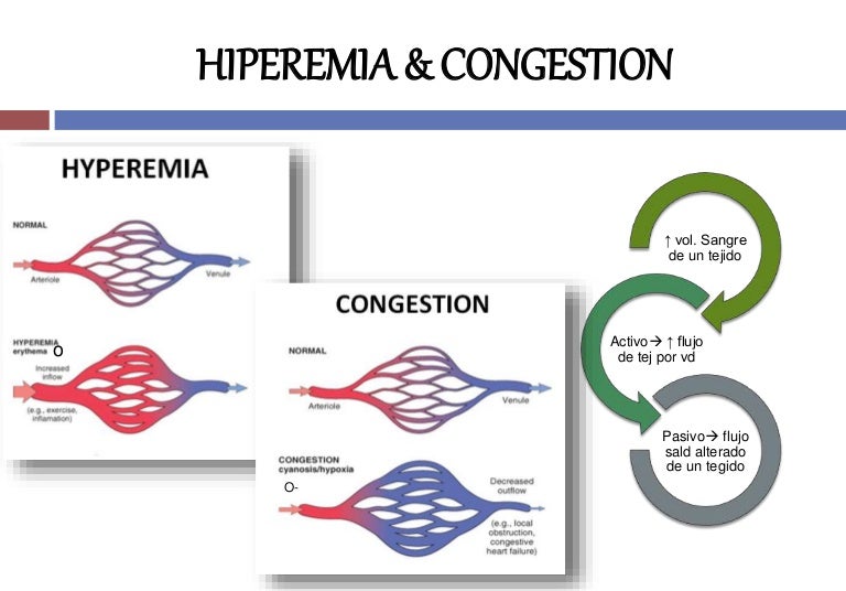 HIPEREMIA Y CONGESTIÓN TRANSTORNOS HEMODINAMICOS