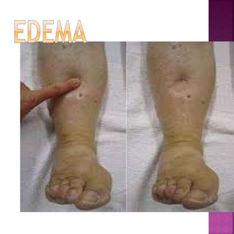 Fisiopatologia Edema | PPTX