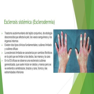 Esclerodermia | PPT