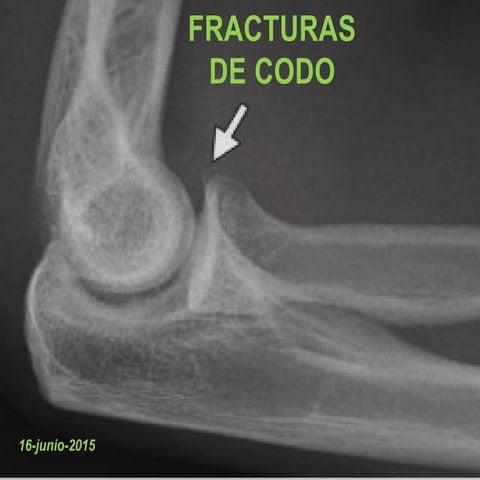 CLASE DE RADIOLOGIA SOBRE FRACTURAS DE CODO | PPTX
