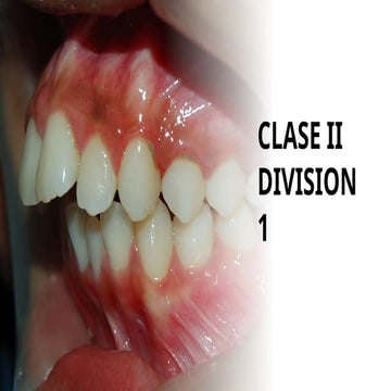 CLASE II tratamiento ortodonticoooo.pptx