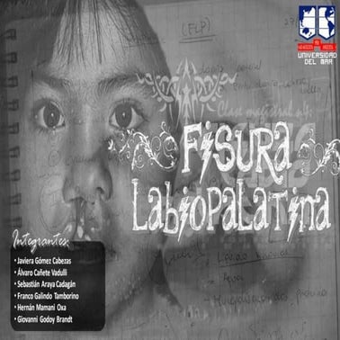 Fisura Labiopalatina y Labio Leporino | PPSX