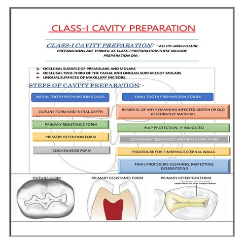 Class 1 cavity preparation | DOCX