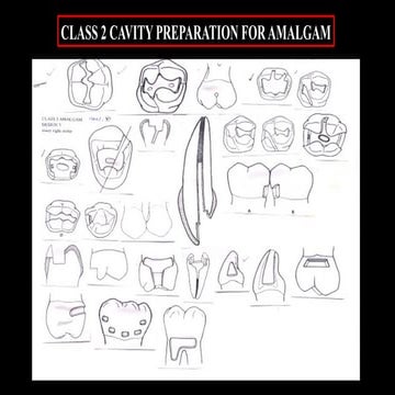 class 2 amalgam restoration CLASS.pptxsj | PPTX