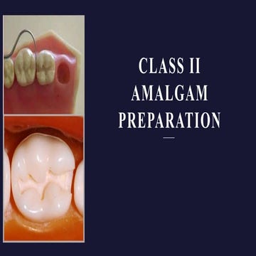 Class 2 Amalgam Restoration