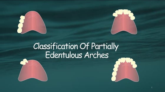 CLASSIFICATION OF REMOVABLE PARTIAL DENTURE.pptx