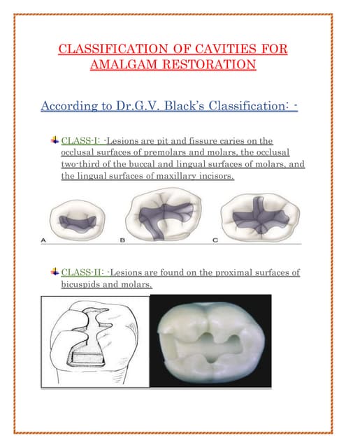 Class 1 cavity preparation | DOCX